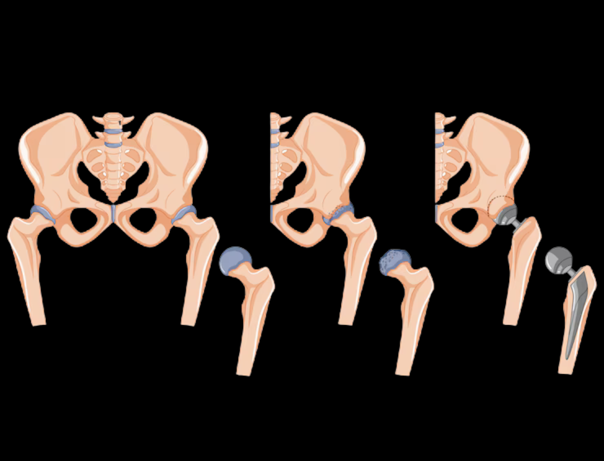 Dr. Anil Kumar Medarametla | Hip Labral Repair | Labrum Tear Treatment ...